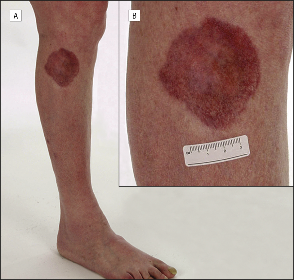Tratamiento con exito de necrobiosis lipoidica con terapia fotodinámica