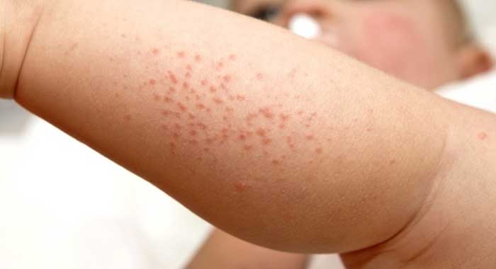 ¿Es contagiosa la culebrilla? Lo que necesitas saber